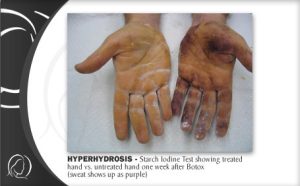 Hyperhydrosis - Minars Dermatology