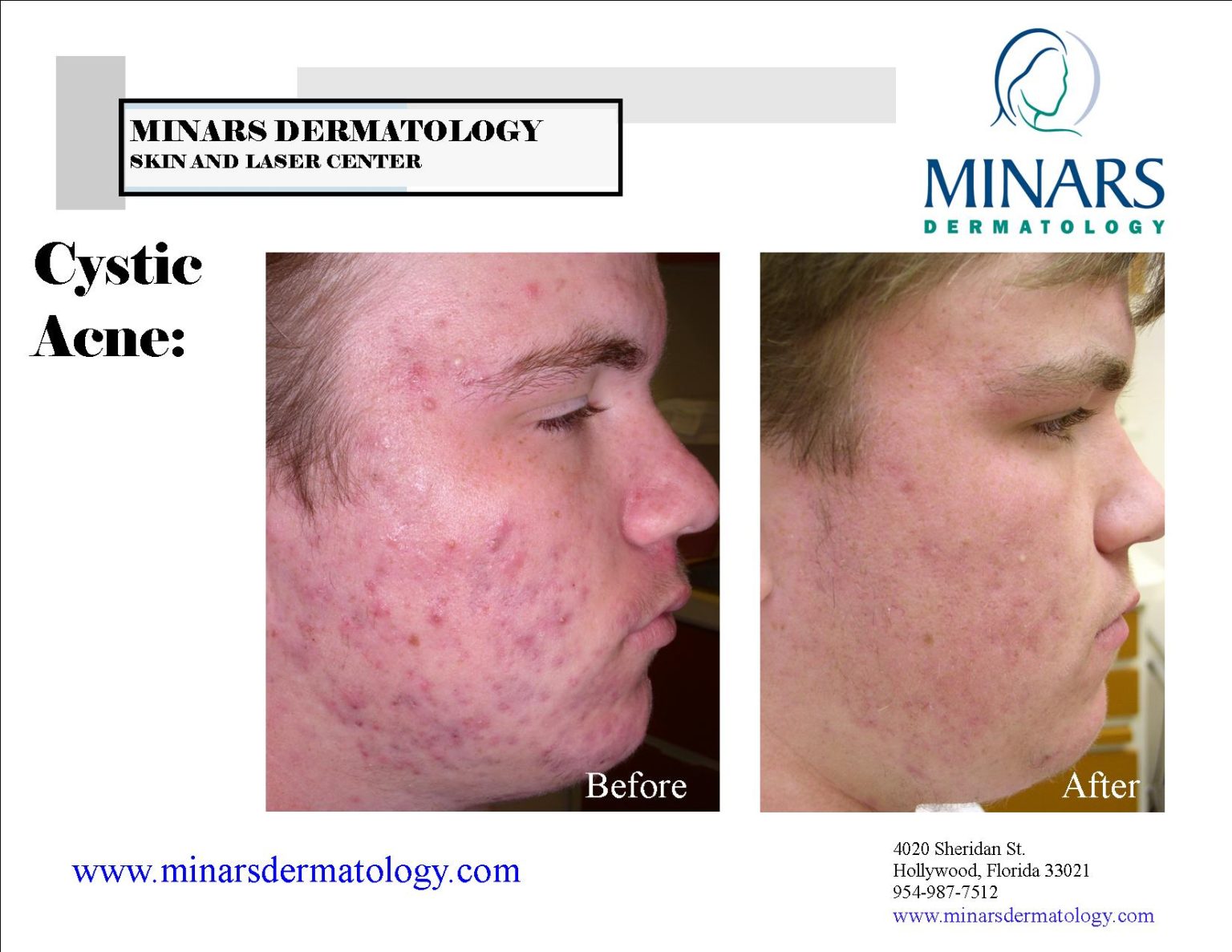 Fraxel Laser Treatment Hollywood, FL - Fractional Laser Near Me ...