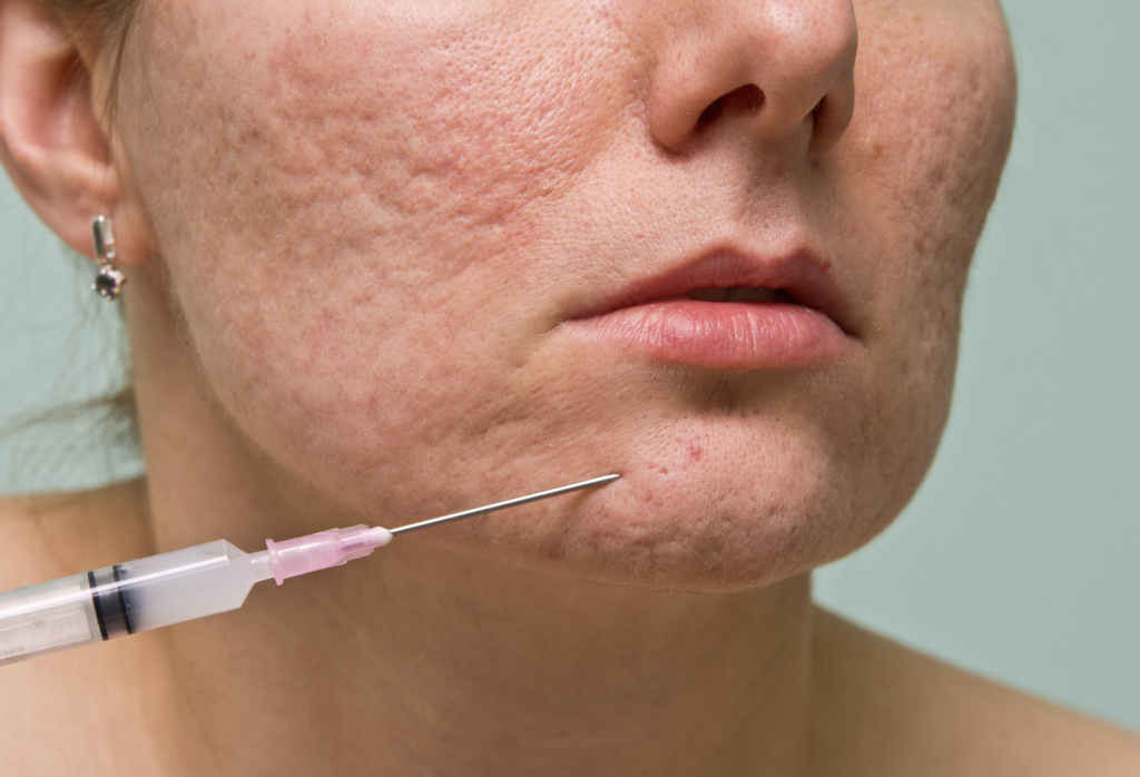 Acne Scar Removal Hollywood, FL - Best Acne Scar Treatment Near You ...