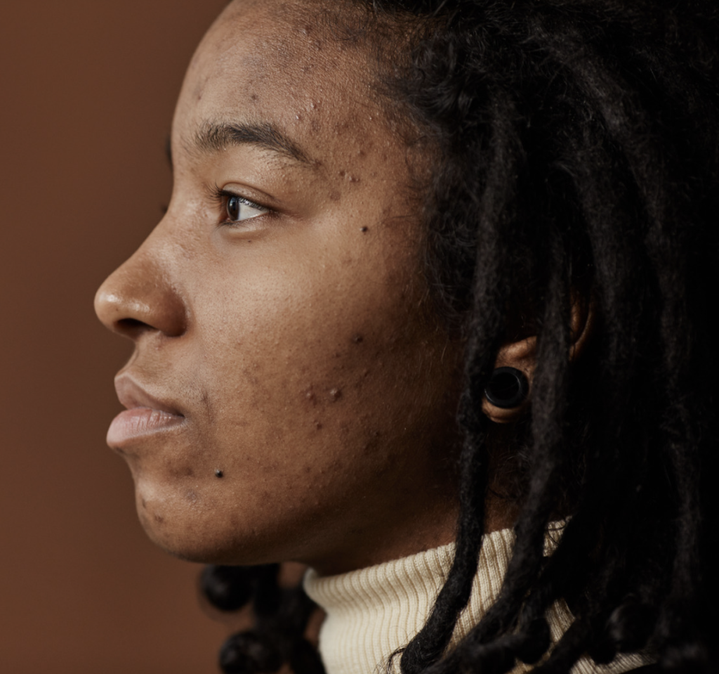 Dermatologist for African American, Black or Brown Skin Near Me in ...