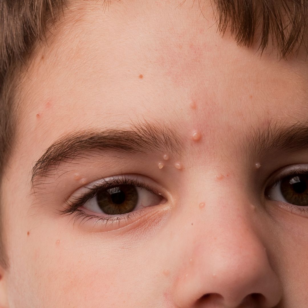 Effective Molluscum Contagiosum Treatments - Beetle Juice For Molluscum ...