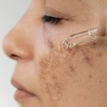 Post Inflammatory Hyperpigmentation – What Causes PIH? - Post ...